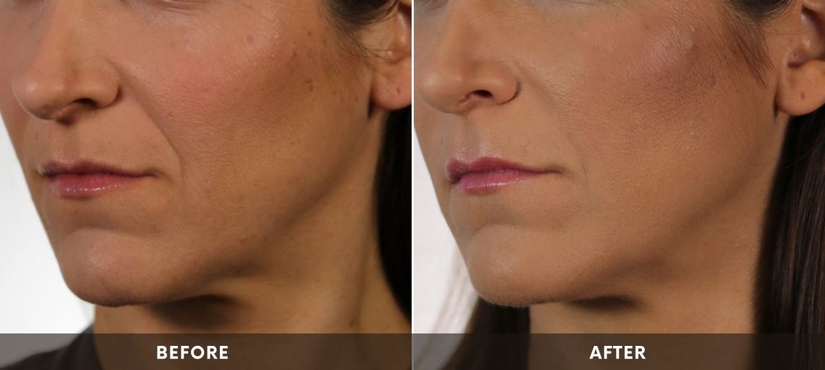 Dermal Fillers | Restore Volume, Plump Lips, Reduce Wrinkles, Fine Lines